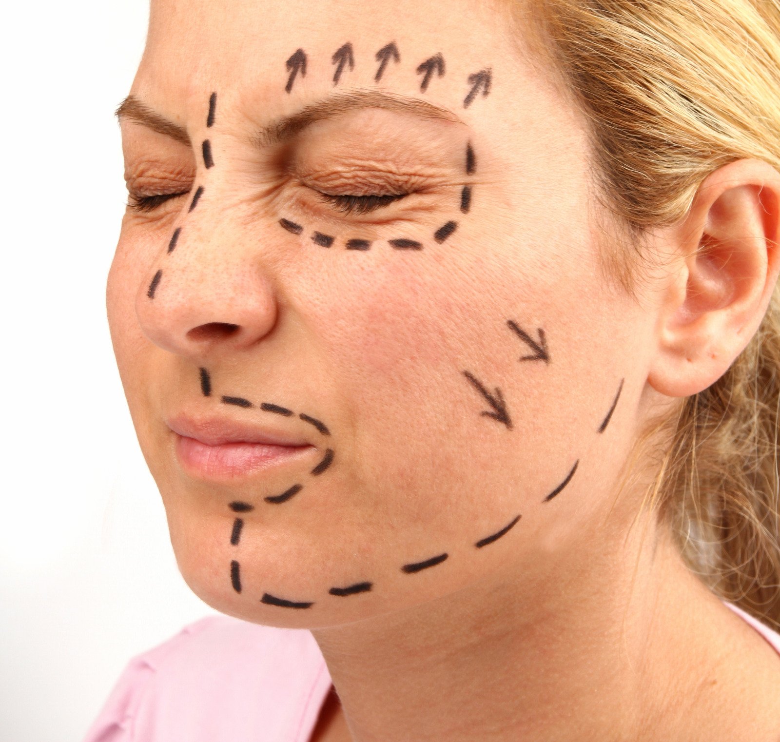 Managing Facelift Surgery Scars | Goodness Care