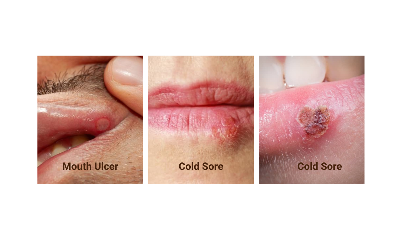 How Mouth Injuries Cause Mouth Ulcers Goodness Care