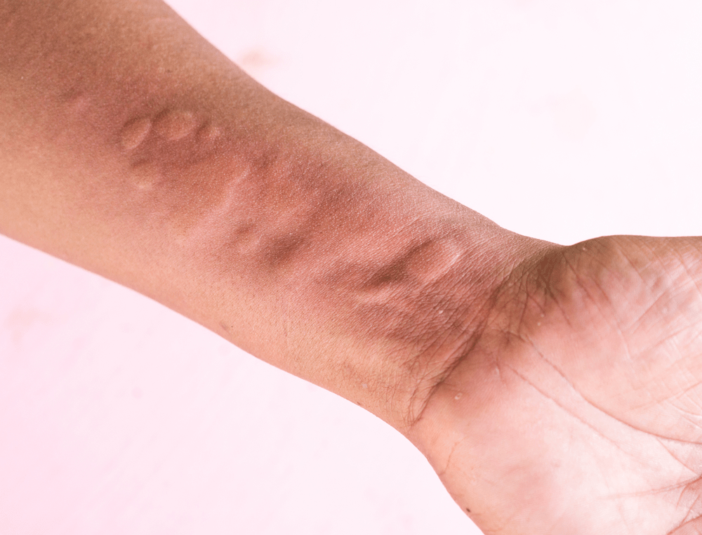 How Enzymes Help Manage Sulfite Sensitivity | Goodness Care