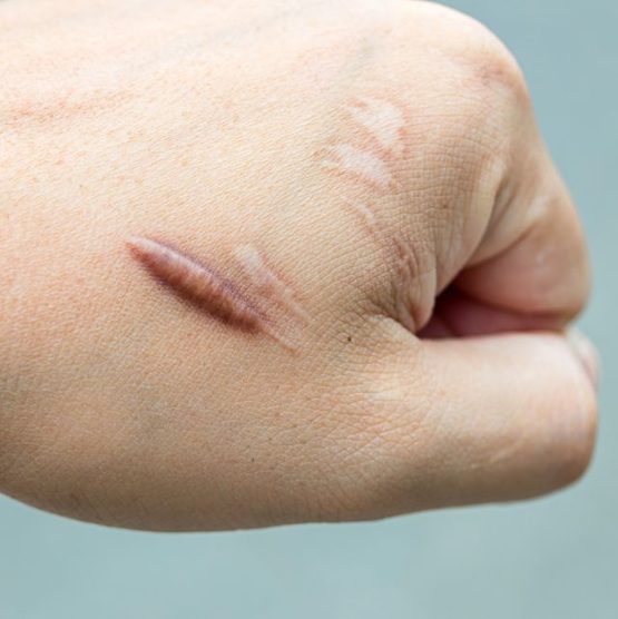 Understanding Burn Scars: A Comprehensive Guide | Goodness Care